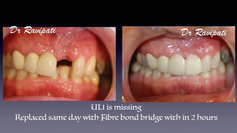 Fibre reinforced - CLAREMONT DENTAL PRACTICE